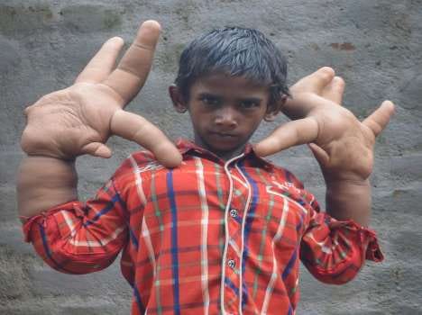 लगातार बढ़ते ही जा रहे हैं ये अतिविशाल हाथ - World's Largest Hands ...