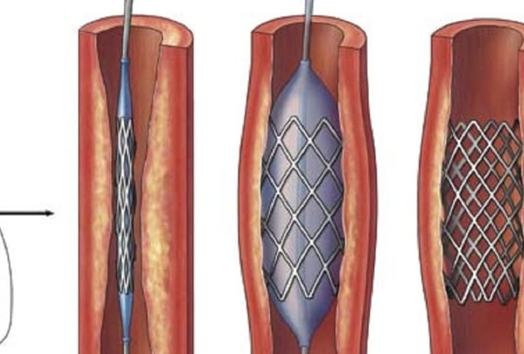 Coronary Stents To Open Heart Blockages Will Now Cost More Due To ...