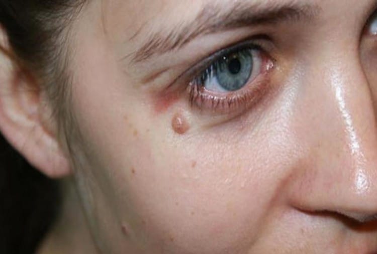 आजमा के देख लें ये घरेलू नुस्खे, 'मस्से' की समस्या हमेशा के लिए कर ...