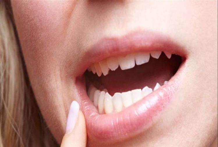 मुंह में छाले रहते हैं तो हो जाएं अलर्ट, कैंसर तक हो सकता है आपको ...