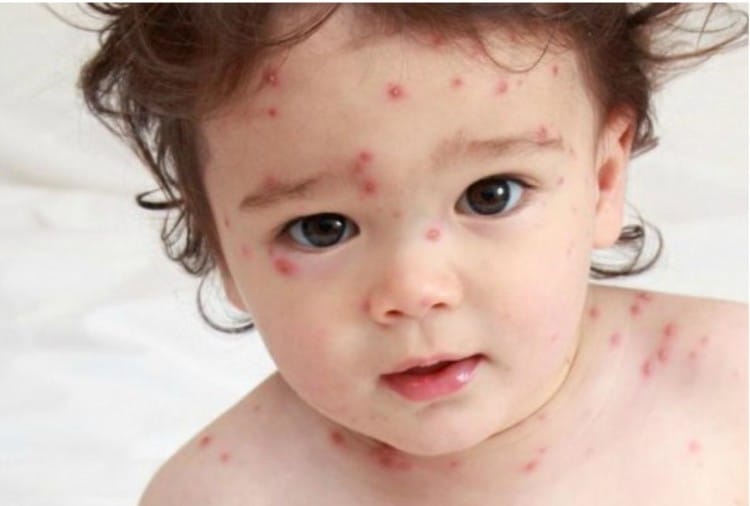 Home Remedies For Chickenpox - Amar Ujala Hindi News Live - चेचक की ...