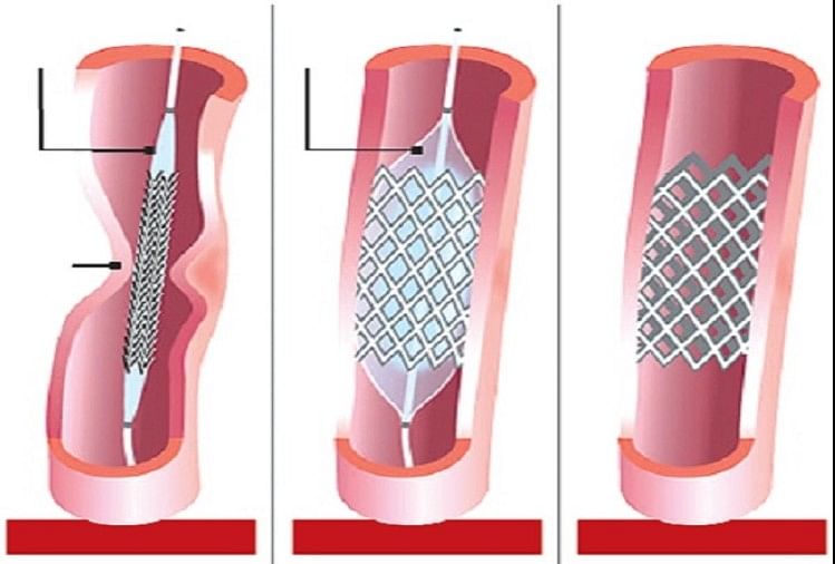 Scientists Made World's Smallest Stent - Amar Ujala Hindi News Live ... Scientists Made World's Smallest Stent - Amar Ujala Hindi News Live ...