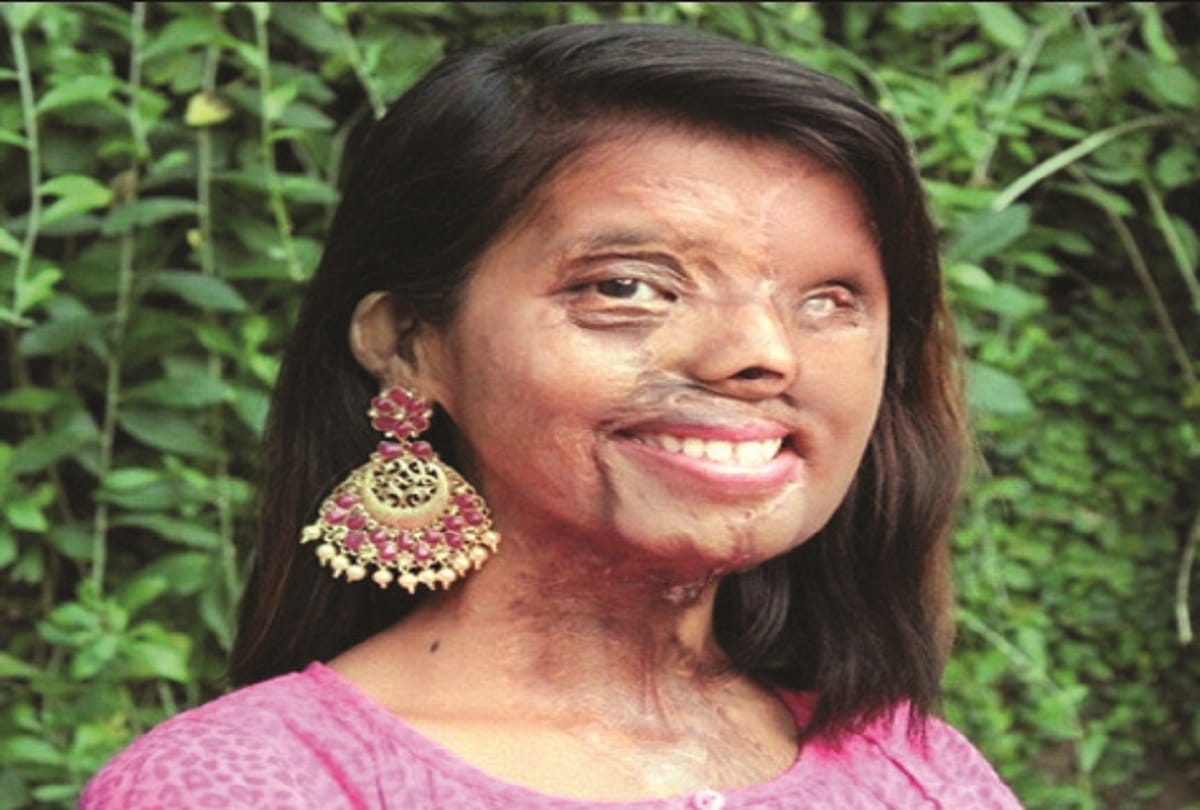 Anmol Rodriguez Acid Attack Survivor Says Life Does Not End With Acid ...