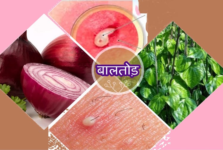 Home Remedies For Boils Due To Hair Breakage, Home Remedies For Baltod ...