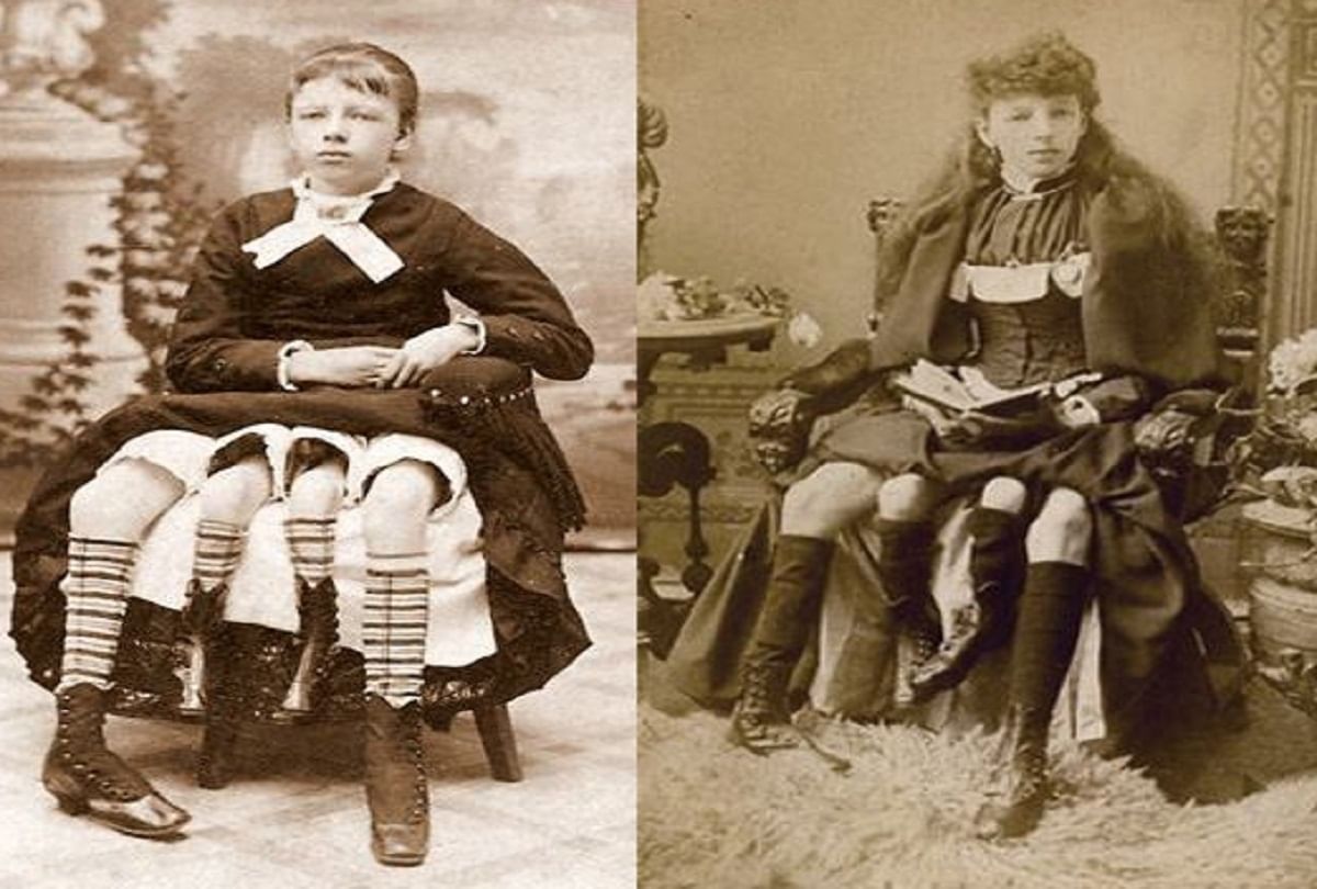 चार टांगों वाली वो अनोखी महिला, जिसने 59 साल तक किया दुनिया को हैरान ...