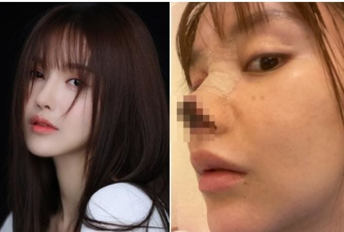 Chinese Singer Gao Liu Nose Surgery Shocking Pictures Goes Viral - Amar ...