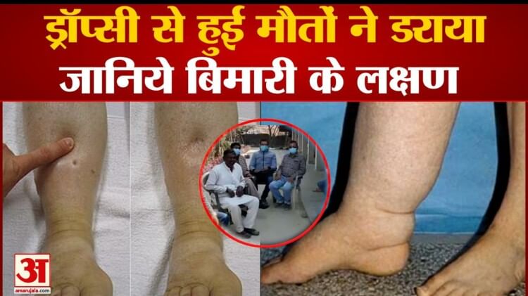 ड्रॉप्सी से तीन लोगों की मौत से मचा हड़कंप,जानिए क्या है बिमारी का कारण ...