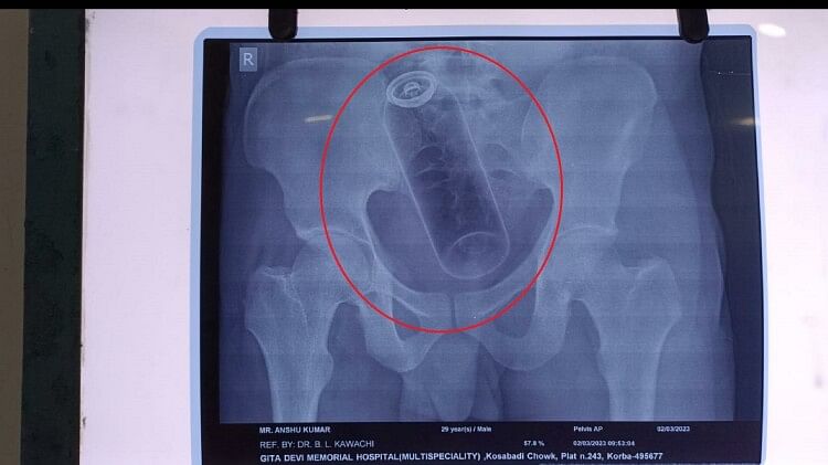 Young Man Put A Bottle Of Deo In The Stomach From The Anus Doctors Took It Out Amar Ujala