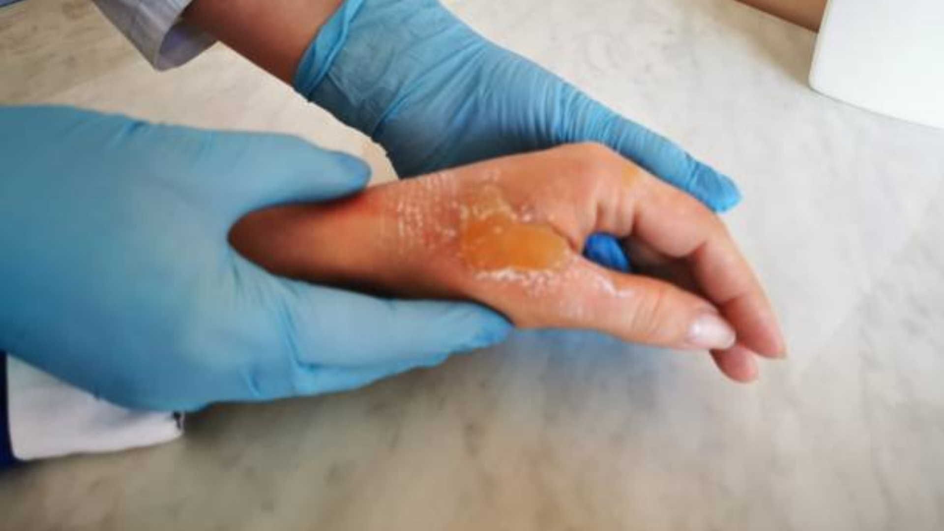 Diwali Health Tips Burnt Hand While Bursting Diwali Crackers Know What ...