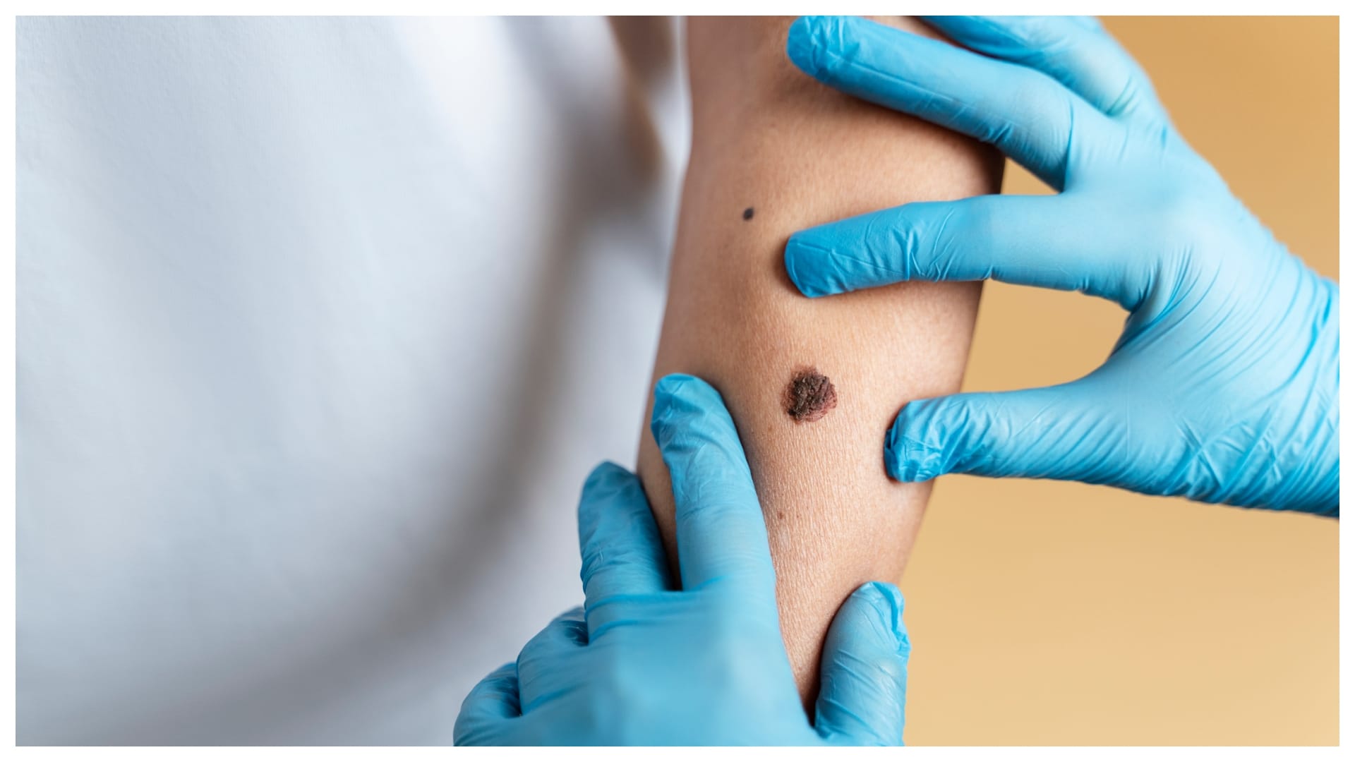 Monkeypox Cases Surge Clade 1b Mpox Variant In Uk Know Its Symptoms And ...