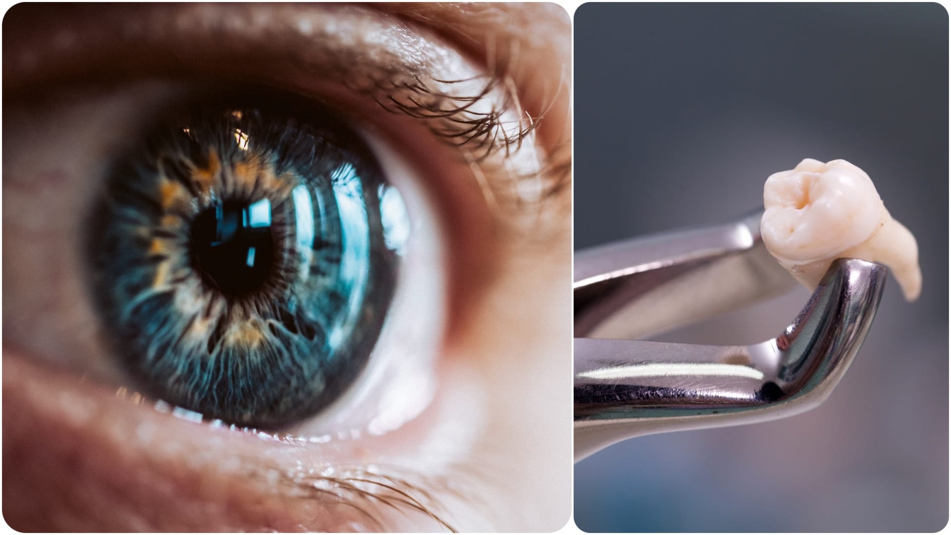 Rare Medical Case In Bihar Tooth Grows Inside Eye Ectopic Tooth Case ...