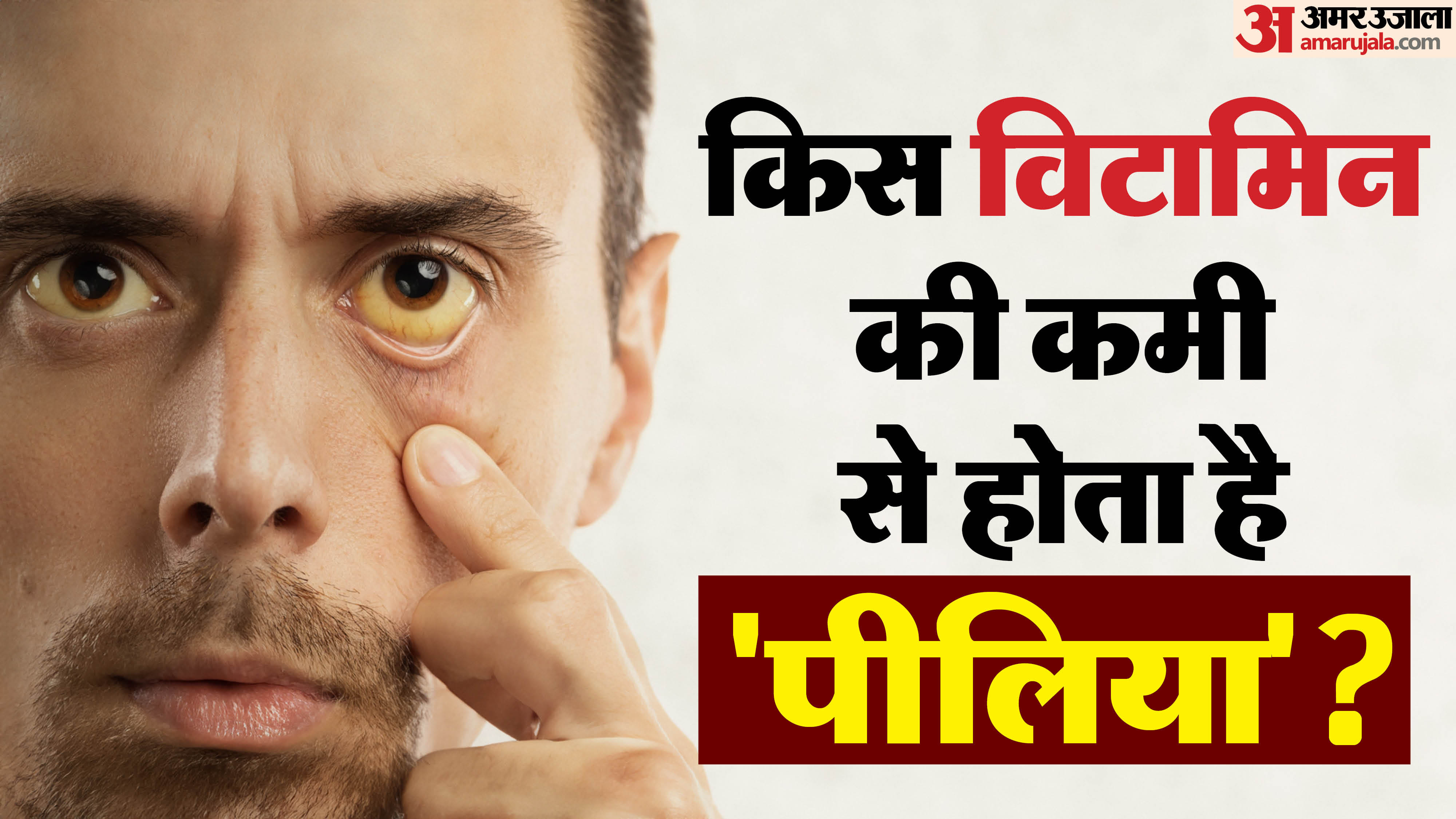 Health Tips:आंखों का पीला होना कहीं 'पीलिया' का संकेत तो नहीं, जानें इस ...