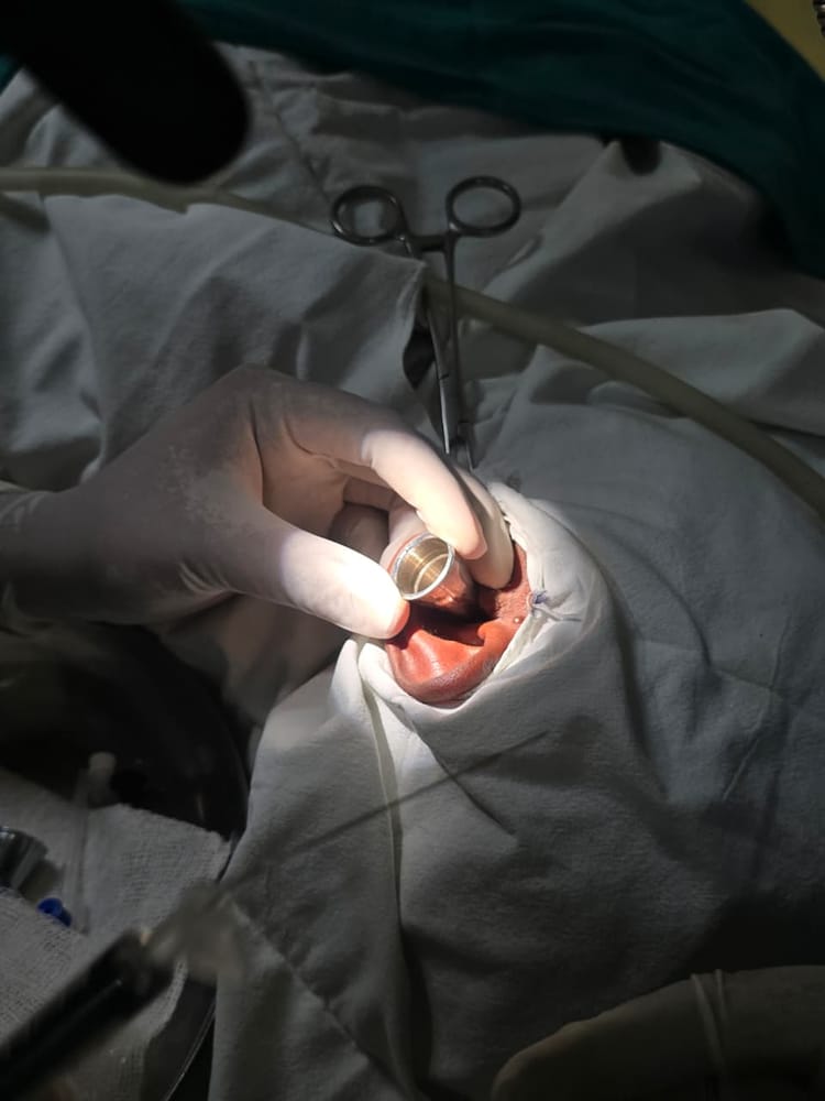 Injection Therapy Given For The First Time In Ent Department ...